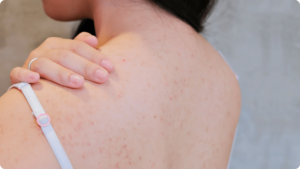 Best Back Acne Treatment | Cara Mia MedSpa Lake Zurich IL
